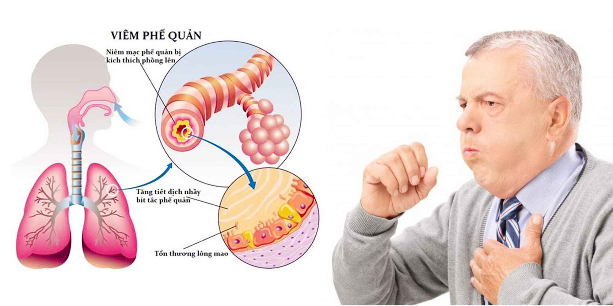 Causes of cough with phlegm - Ypharco